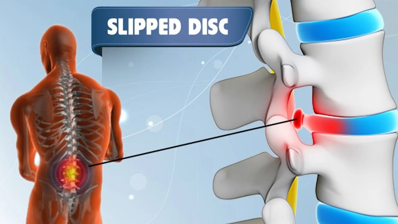 Slip Disc: Punca, Rawatan, dan Peranan Suplemen Polifenol – VIVIX RES-V ...